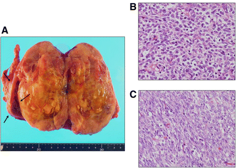 Clear cell sarcoma of the kidney distinguished from synovial sarcoma ...