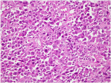 Plasmablastic lymphoma of the oral cavity with breast recurrence: a ...