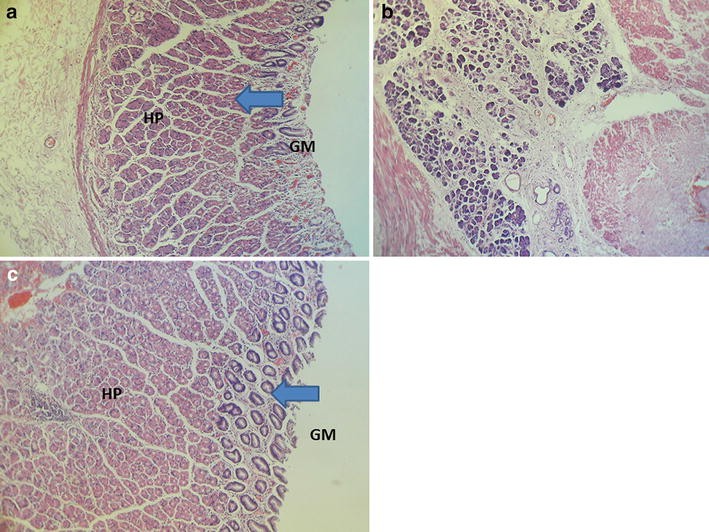 Gastric fundal heterotopic pancreas mimicking a gastrointestinal ...