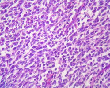 Round cell sarcoma of the colon with CIC rearrangement | BMC Research ...