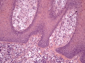 Oral verruciform xanthoma and erythroplakia associated with chronic ...