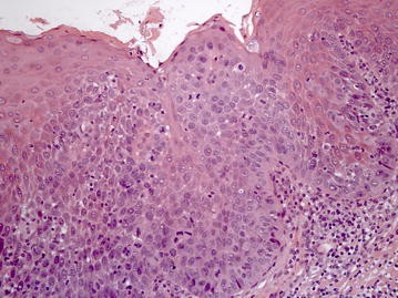 Oral verruciform xanthoma and erythroplakia associated with chronic ...