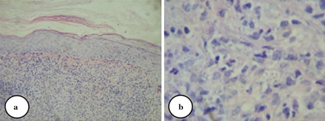A pyoderma gangrenous-like cutaneous leishmaniasis in a Libyan woman ...