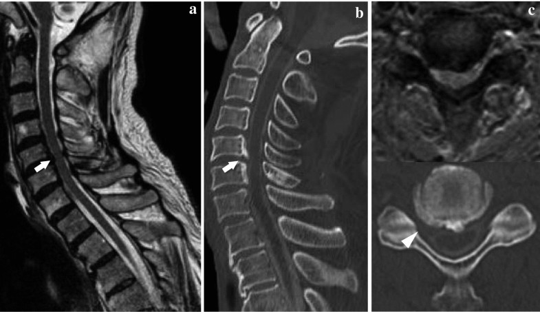 Surgical treatment for dropped head syndrome with cervical spondylotic ...