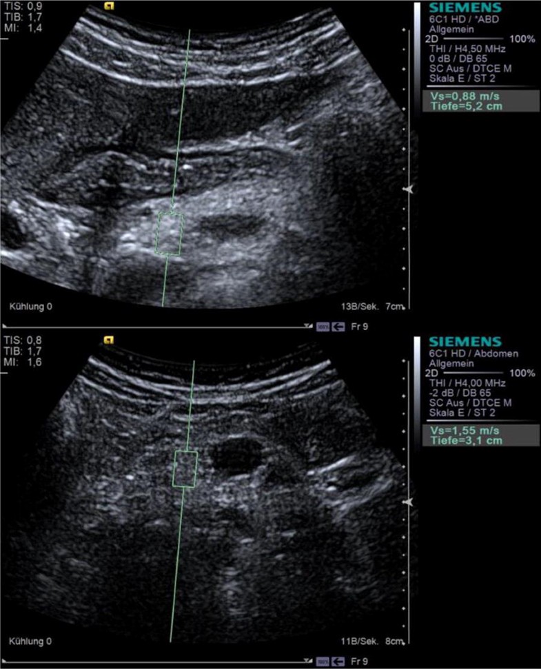 Diagnostic accuracy of MRI with MRCP and B-Mode-sonography with ...
