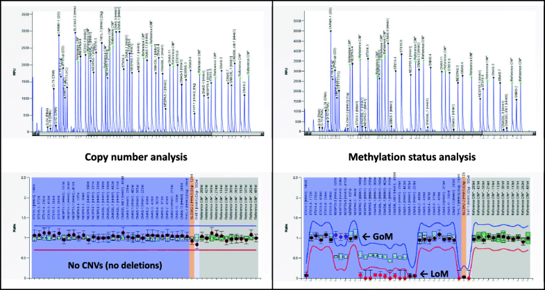 Association of GNAS imprinting defects and deletions of chromosome 2 in ...