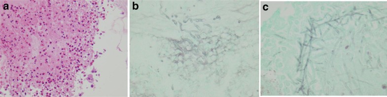 Sinobronchial allergic mycosis syndrome in an elderly male | Allergy ...