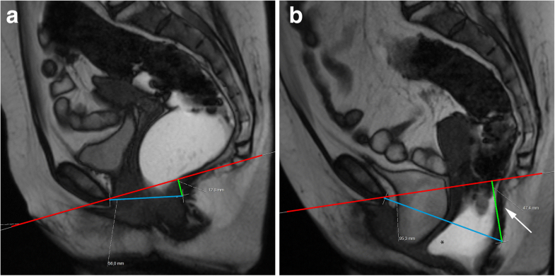 Dynamic magnetic resonance imaging of the female pelvic floor—a ...