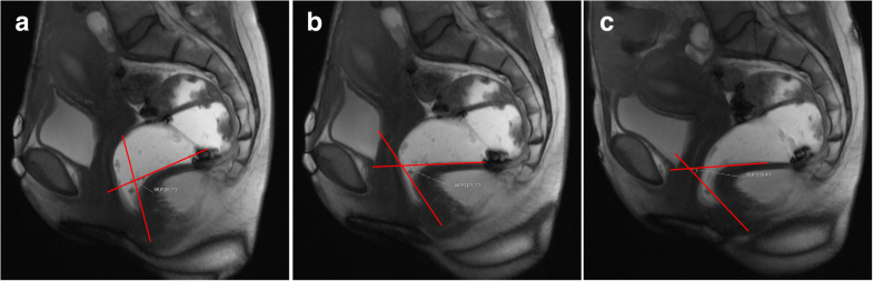 Dynamic Magnetic Resonance Imaging Of The Female Pelvic Floor—a