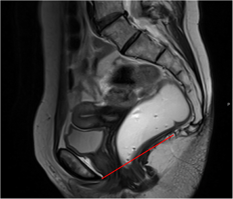 Dynamic magnetic resonance imaging of the female pelvic floor—a ...