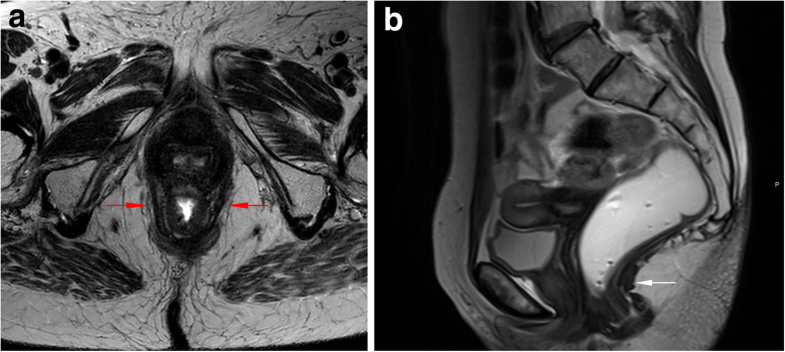 Dynamic Magnetic Resonance Imaging Of The Female Pelvic Floor—a Pictorial Review Insights Into