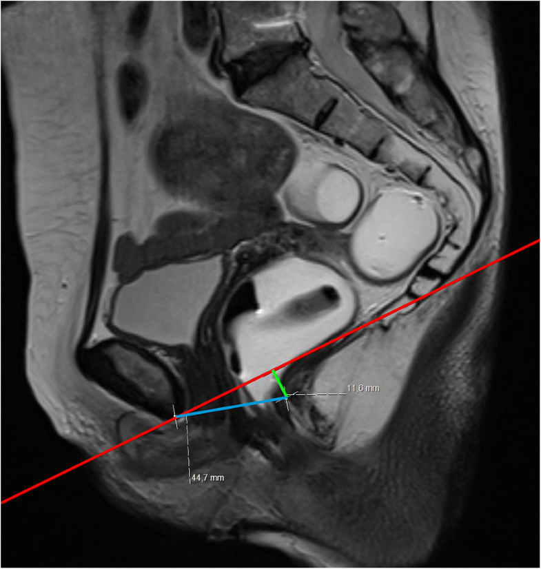 Dynamic Magnetic Resonance Imaging Of The Female Pelvic Floor—a