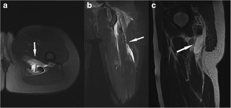 Imaging of hip and thigh muscle injury: a pictorial review | Insights ...