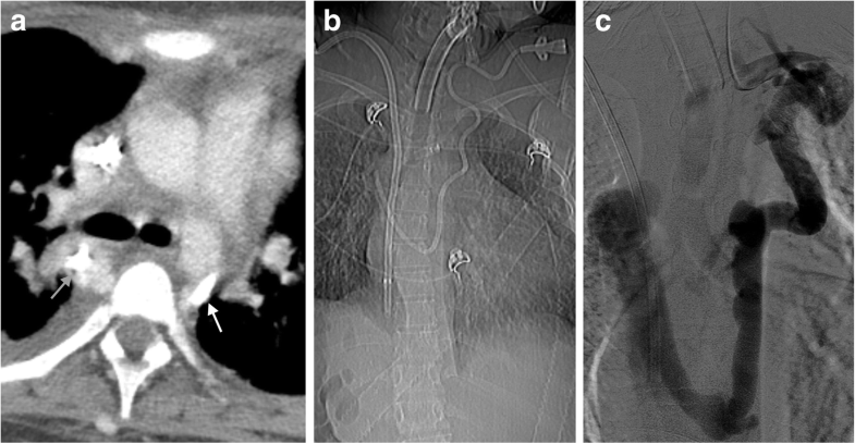 Blood finds a way: pictorial review of thoracic collateral vessels ...