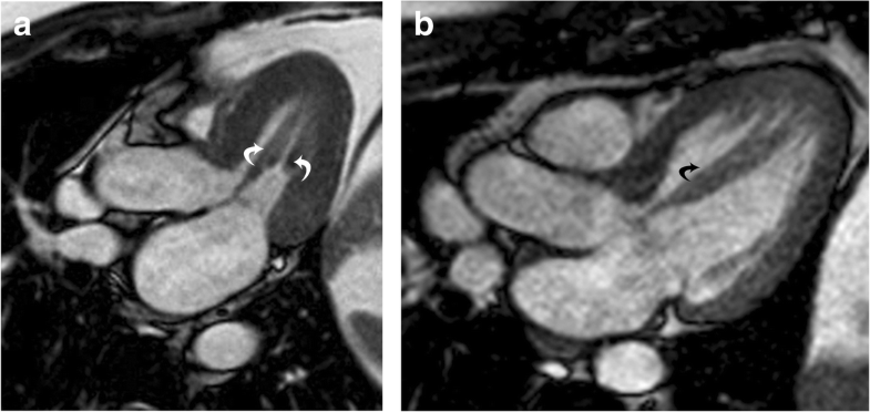 Magnetic resonance imaging of the papillary muscles of the left ...