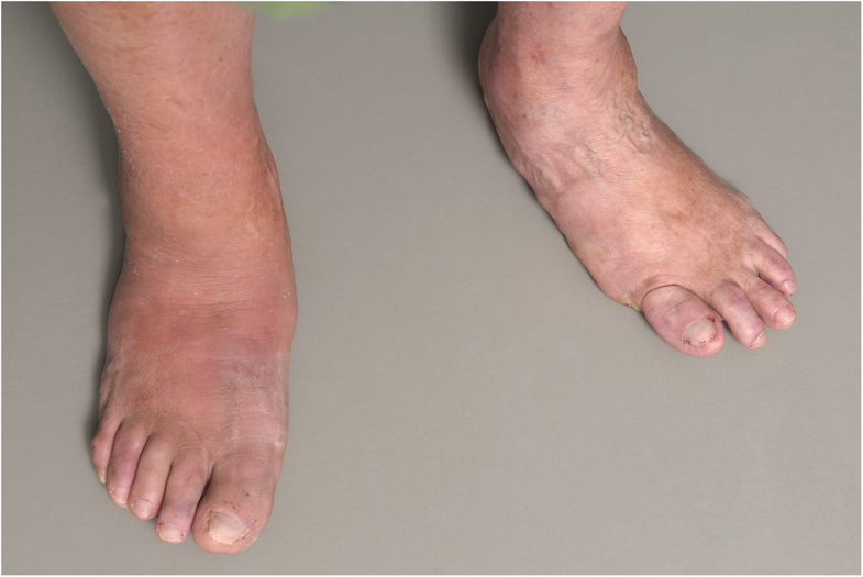 The Charcot foot: a pictorial review | SpringerLink