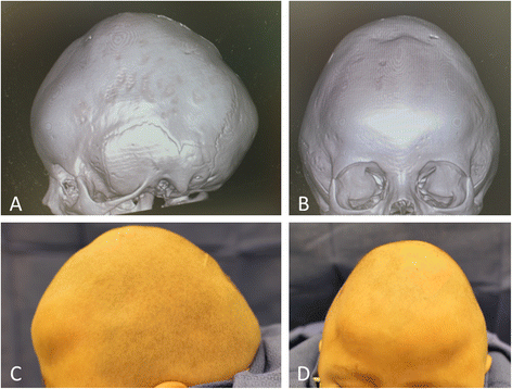 Pancraniosynostosis following endoscopic-assisted strip craniectomy for ...