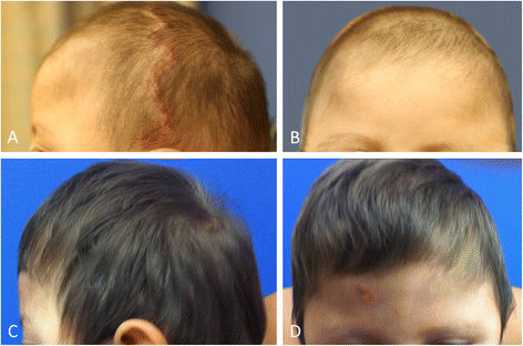 Pancraniosynostosis following endoscopic-assisted strip craniectomy for ...