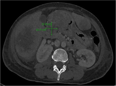 The inferior vena cava (IVC) syndrome as the initial manifestation of ...