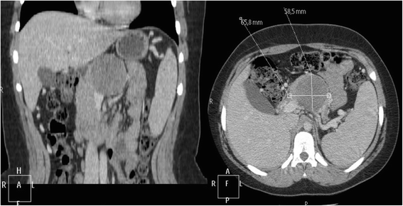Solid pseudopapillary tumor of the pancreas (Frantz’s tumor): two case reports and a review of ...