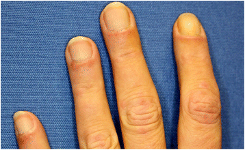 A mild form of dermatomyositis as a prodromal sign of lung ...
