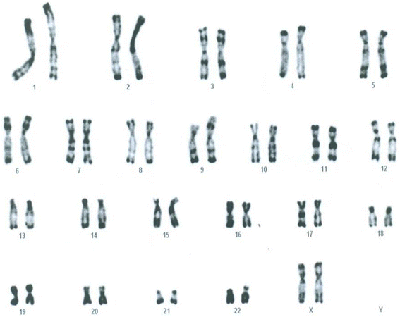 Insulin-like growth factor type 1 deficiency in a Moroccan patient with ...