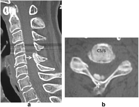 Acute neck pain caused by pseudogout attack of calcified cervical ...