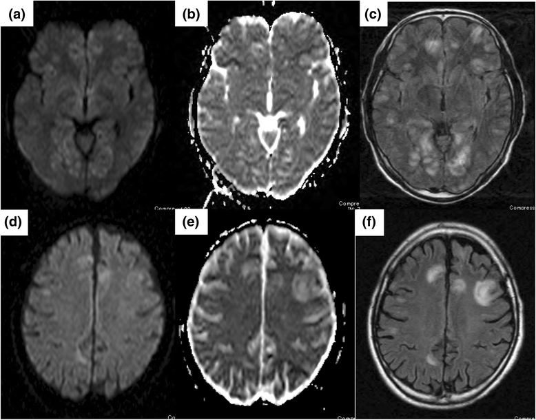 Hemophagocytic lymphohistiocytosis with leukoencephalopathy in a ...