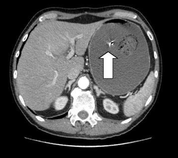A rare case of a double phytobezoar causing gastric and jejunum ...