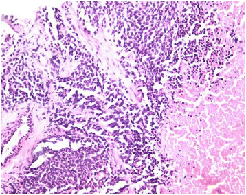 Embryonal rhabdomyosarcoma of the perineum in an adult: a case report ...