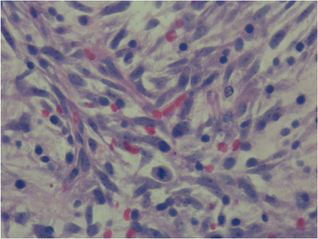 A rare presentation of myxofibrosarcoma as a Pancoast tumor: a case ...