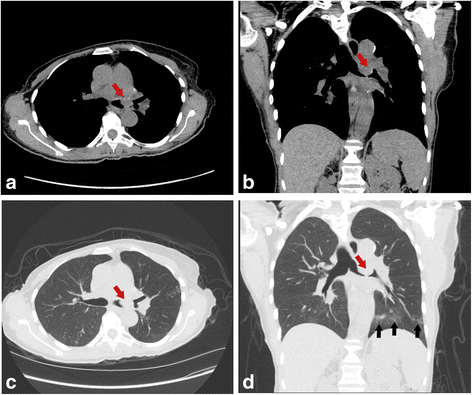 A novel presentation of Mycobacterium avium complex in a recipient of a lung transplant: a case ...