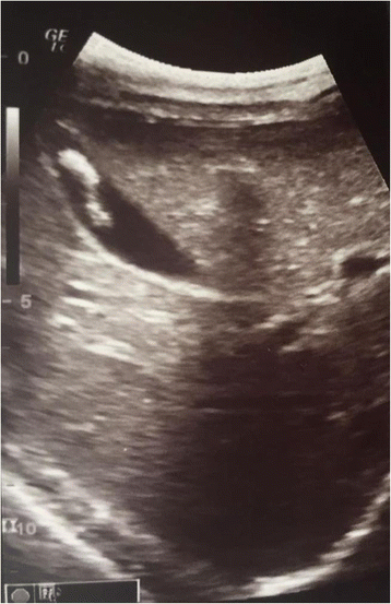 Gallbladder ascariasis in Kosovo – focus on ultrasound and conservative ...