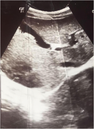 Gallbladder ascariasis in Kosovo – focus on ultrasound and conservative ...