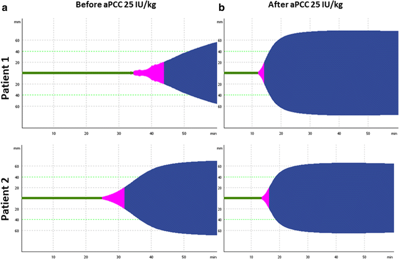 Activated prothrombin complex concentrate to reverse the factor Xa ...