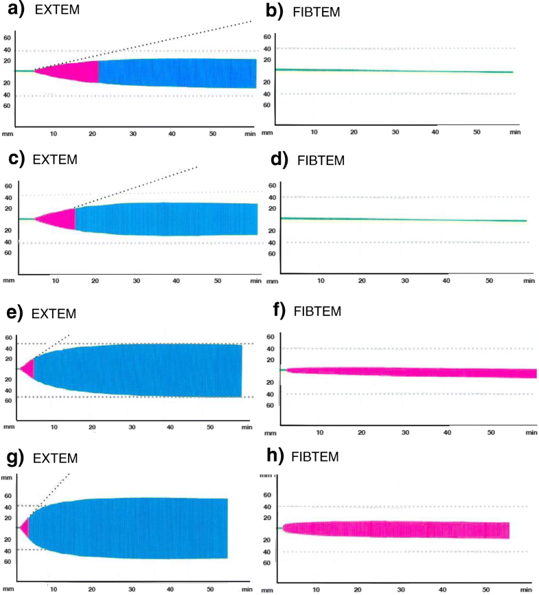 Thromboelastometry-guided hemostatic therapy for hemorrhagic shock in ...