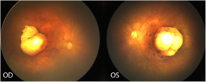 Ocular abnormalities in congenital Zika syndrome: a case report, and ...