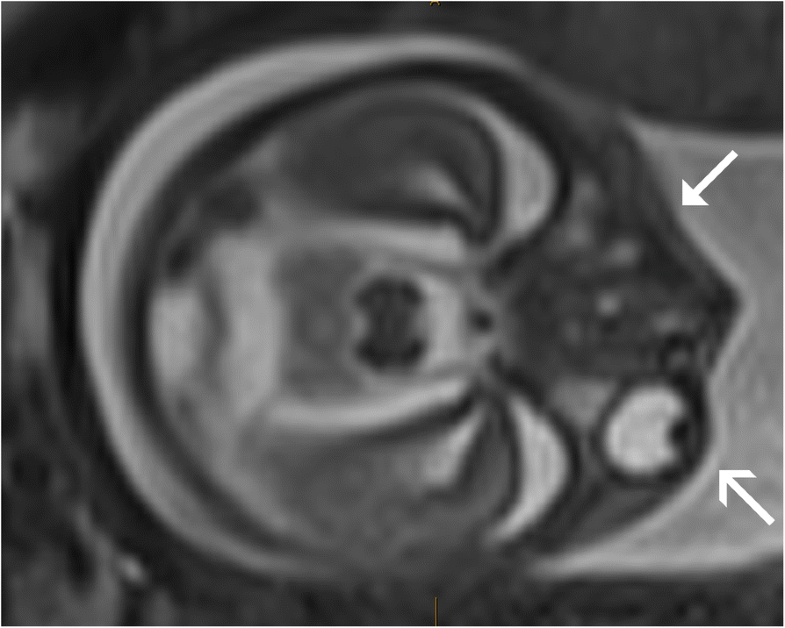 Prenatal diagnosis and implications of microphthalmia and anophthalmia ...