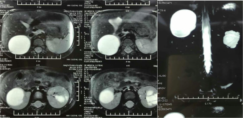 Robotic renal cyst decortication with calyceal diverticulectomy in a ...