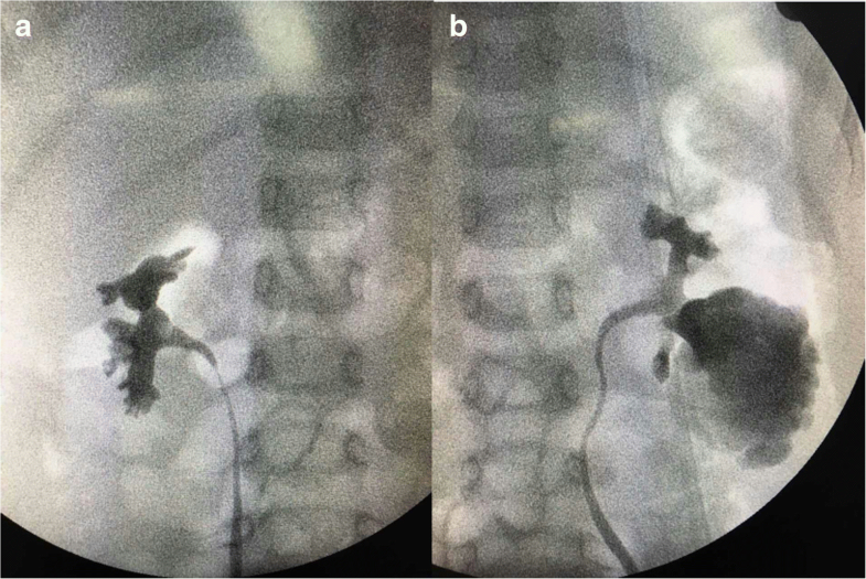 Robotic renal cyst decortication with calyceal diverticulectomy in a ...
