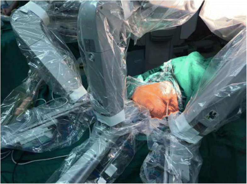 Robotic renal cyst decortication with calyceal diverticulectomy in a ...