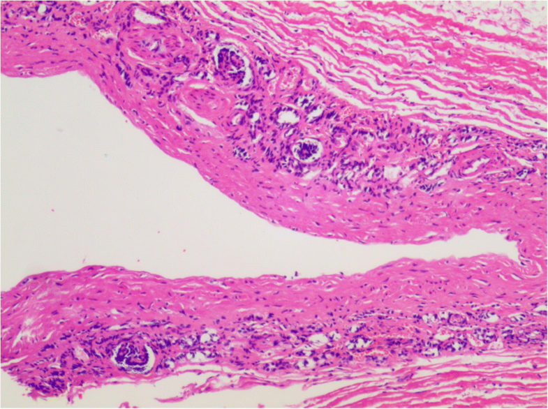 Robotic renal cyst decortication with calyceal diverticulectomy in a ...