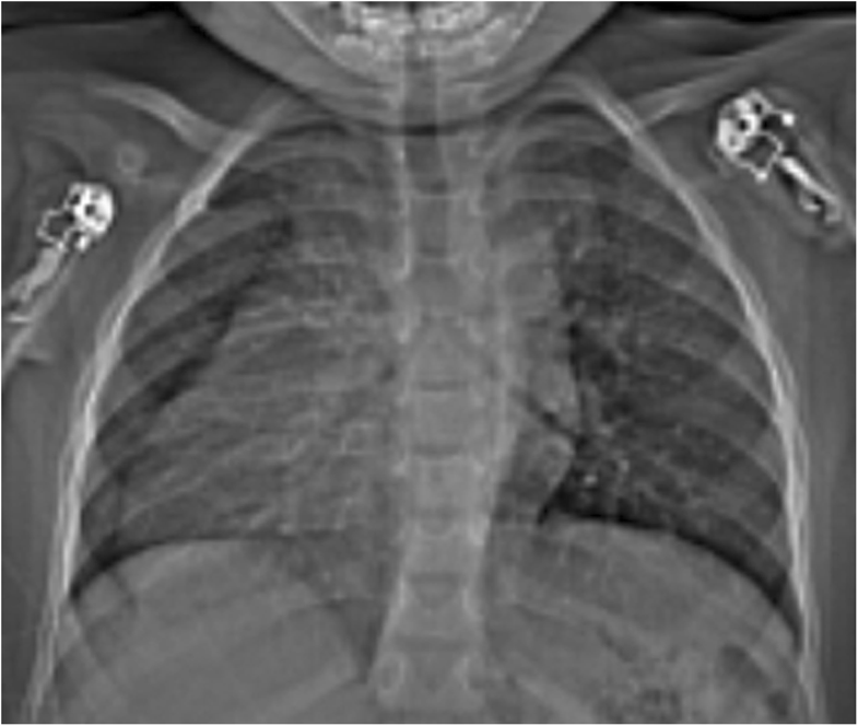 Complex congenital cardiac anomalies in the setting of right isomerism ...