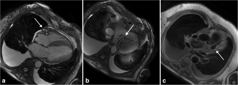 An unusual presentation of anomalous left coronary artery from the ...