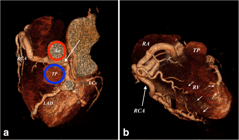 An unusual presentation of anomalous left coronary artery from the ...