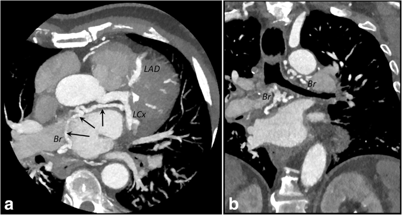 An unusual presentation of anomalous left coronary artery from the ...