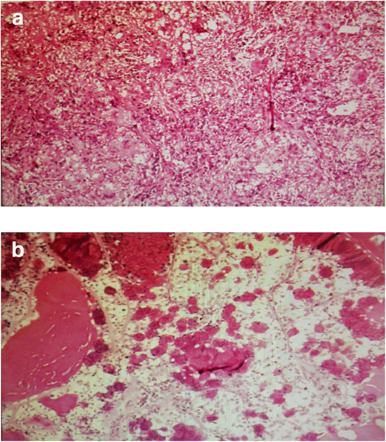Pulmonary cryptococcosis coexisting with adenocarcinoma: a case report ...