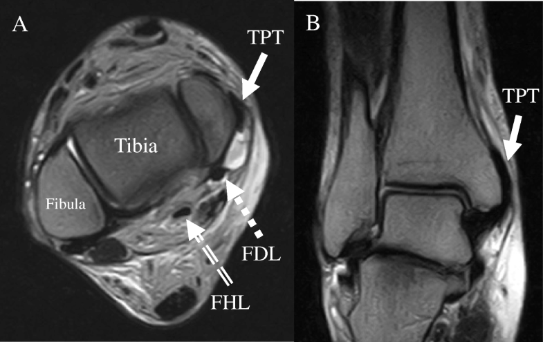 Early surgical management of traumatic dislocation of the tibialis ...