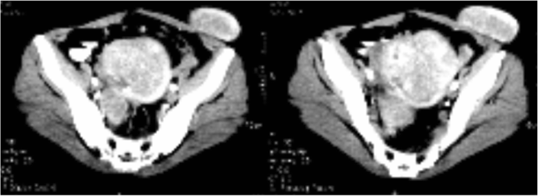 Port site parasitic leiomyoma after laparoscopic myomectomy: a case ...