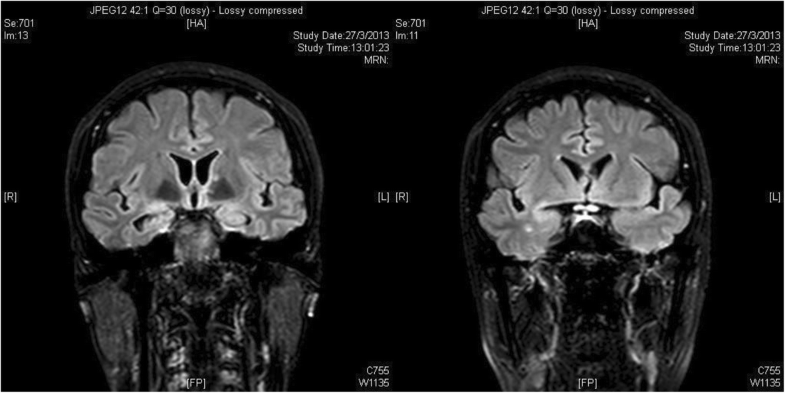 Optic neuritis as the initial clinical presentation of limbic ...